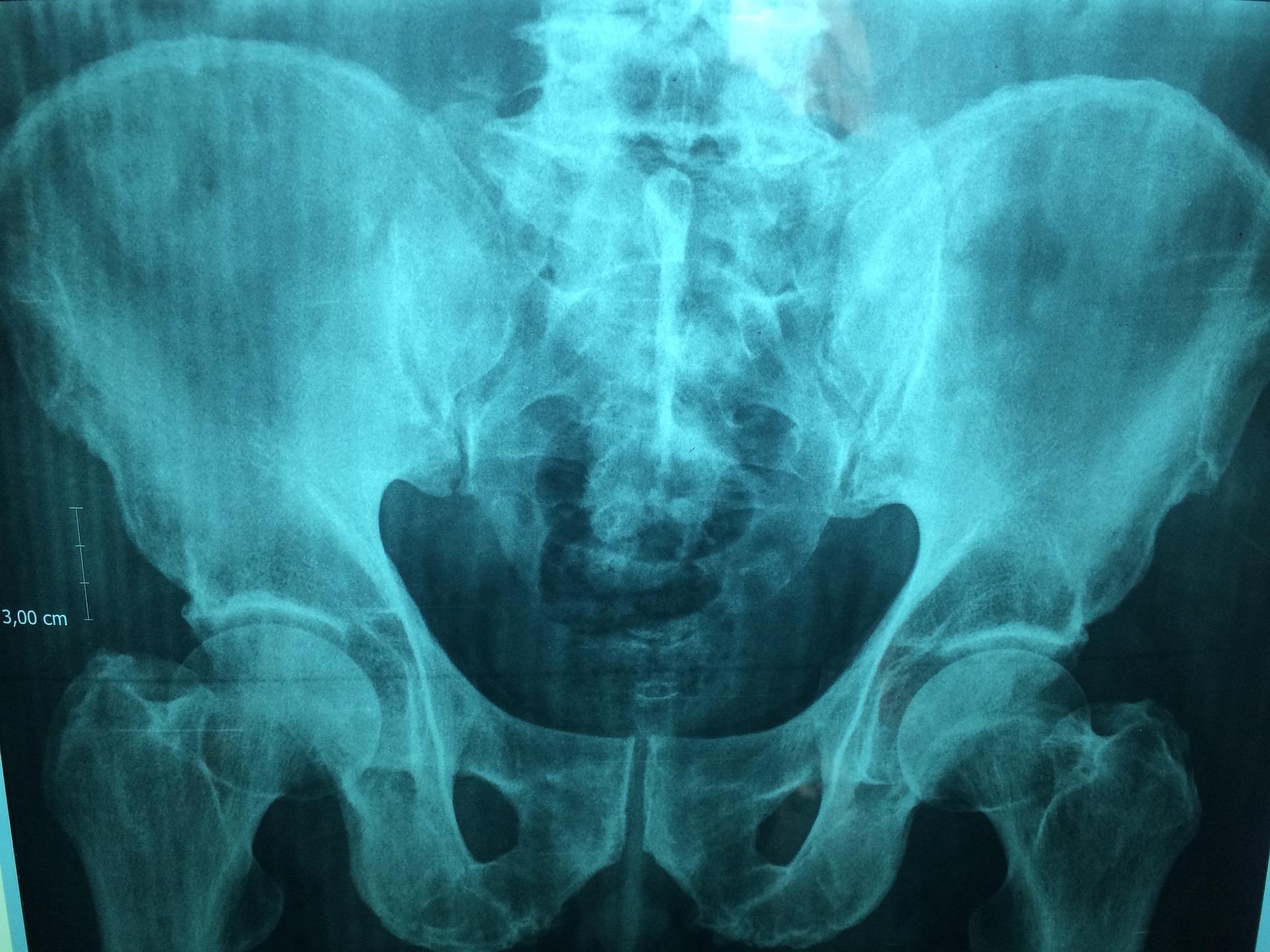 Biomet M2A Lawsuits | Cincinnati Hip Implant Attorney | The Lyon Firm